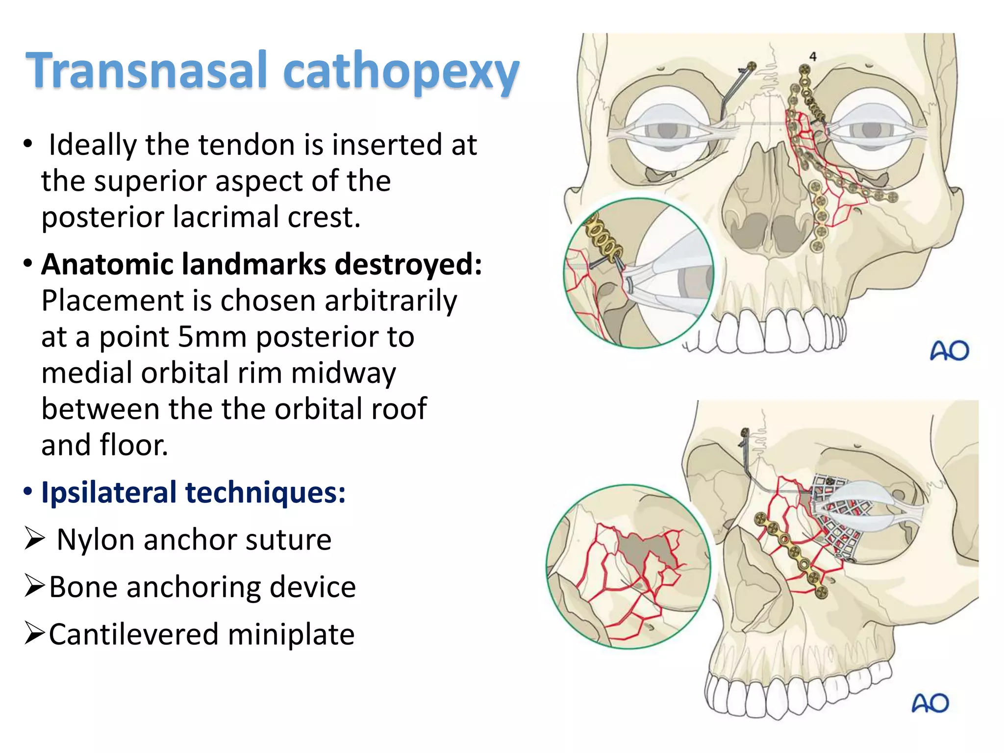 Naso-orbital-ethmoid (NOE) fractures: Management principles, options ...
