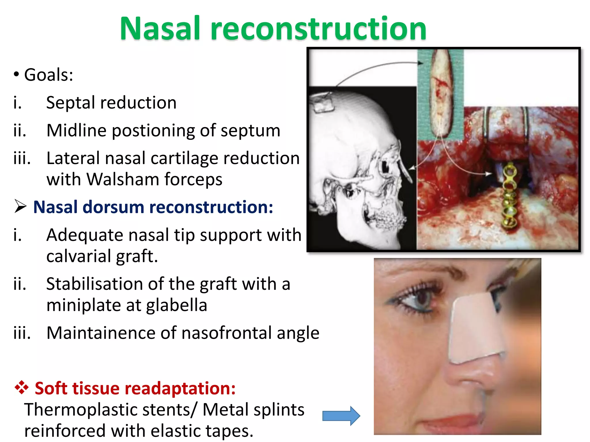 Naso-orbital-ethmoid (NOE) fractures: Management principles, options ...
