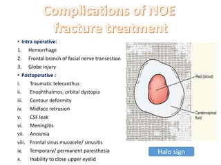 Naso-orbital-ethmoid (NOE) fractures: Management principles, options and recent advances | PPTX
