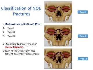 Naso-orbital-ethmoid (NOE) fractures: Management principles, options ...