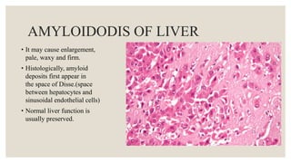 AMYLOIDOSIS | PPTX