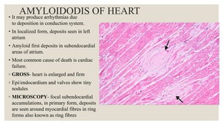 AMYLOIDOSIS | PPTX