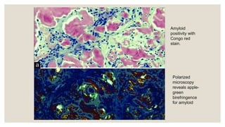 AMYLOIDOSIS | PPTX