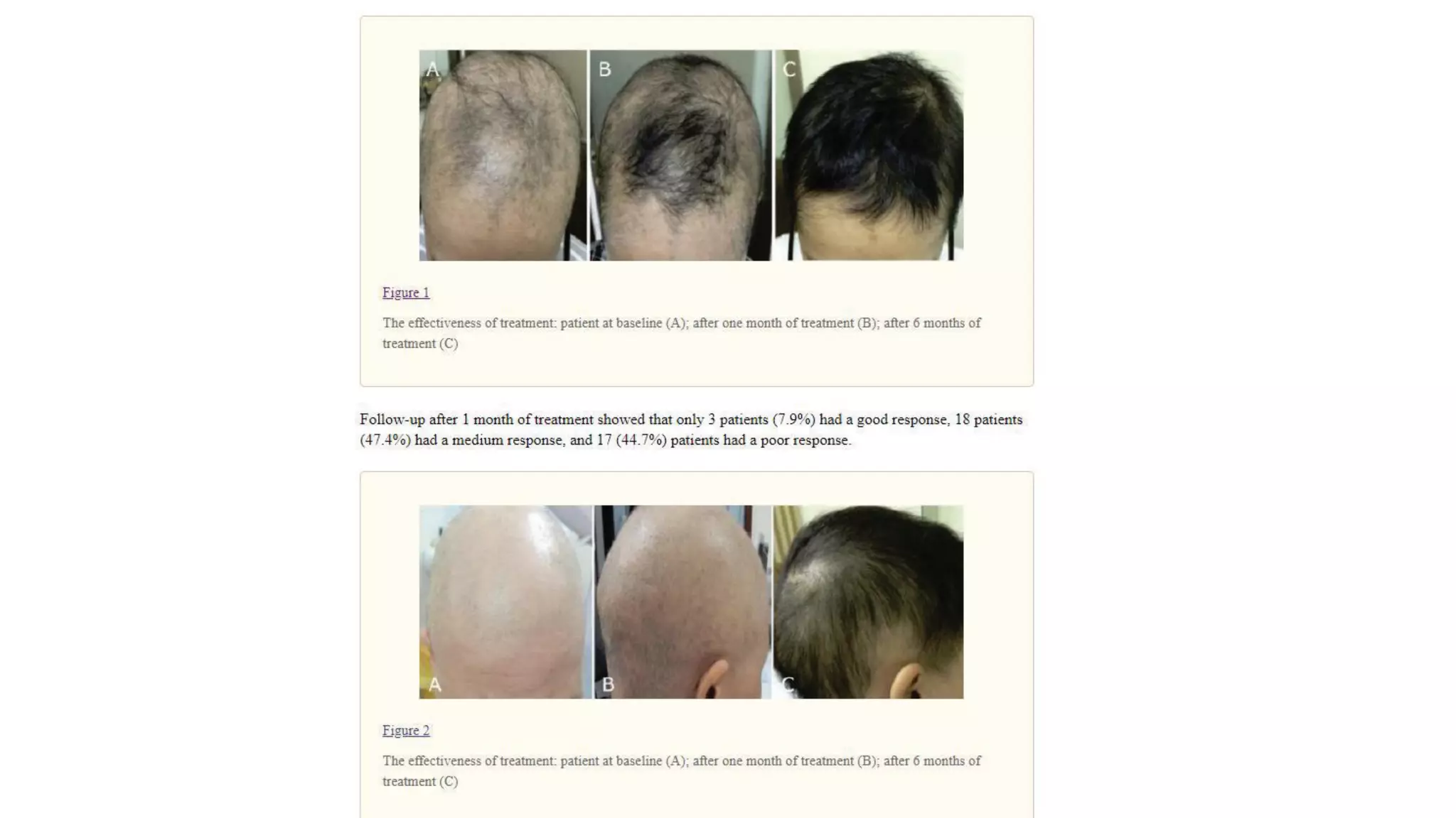 Pediatric Alopecia Areata: What's New in Management, Treatment and ...