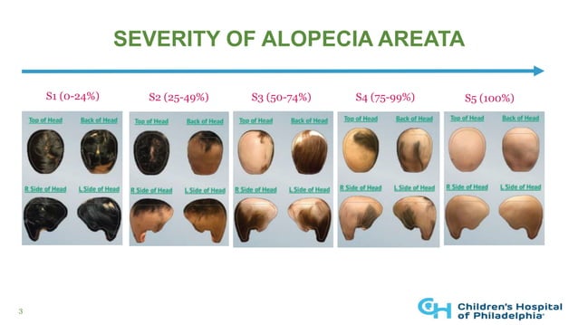 Pediatric Alopecia Areata: What's New in Management, Treatment and ...