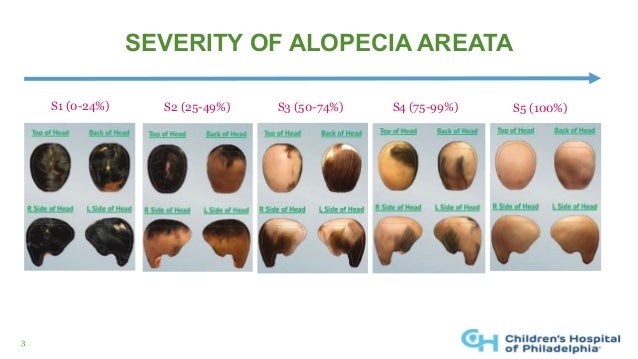 Pediatric Alopecia Areata: What's New in Management, Treatment and Ed…