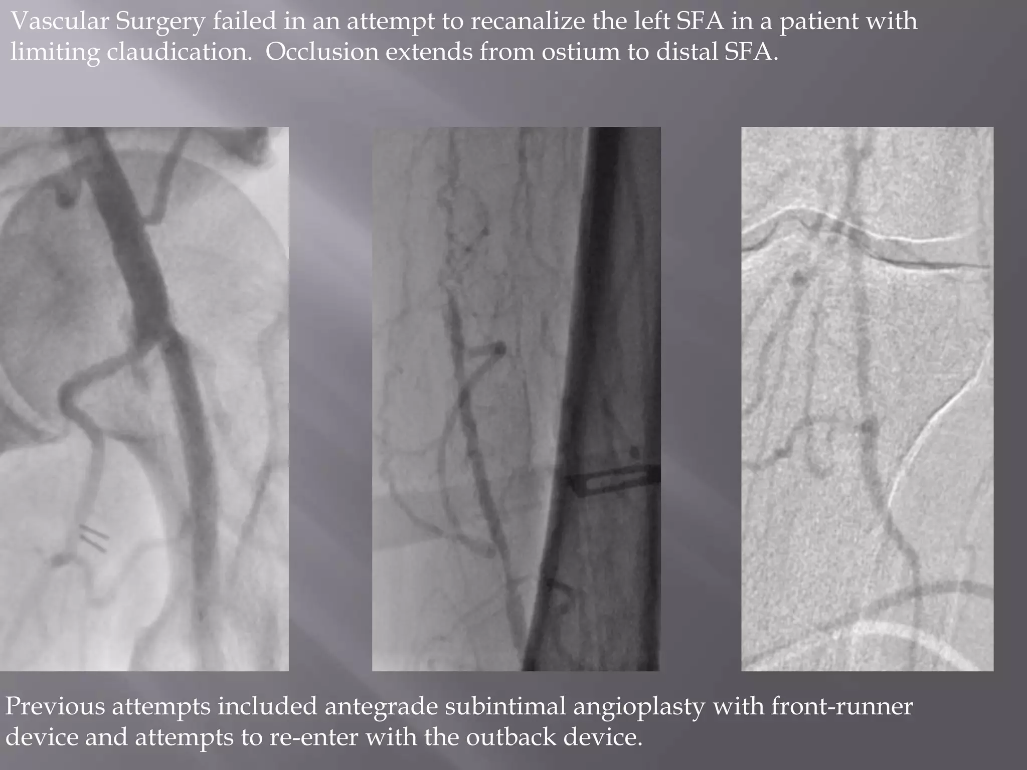 Transpedal SFA revascularization using outback re-entry | PPT