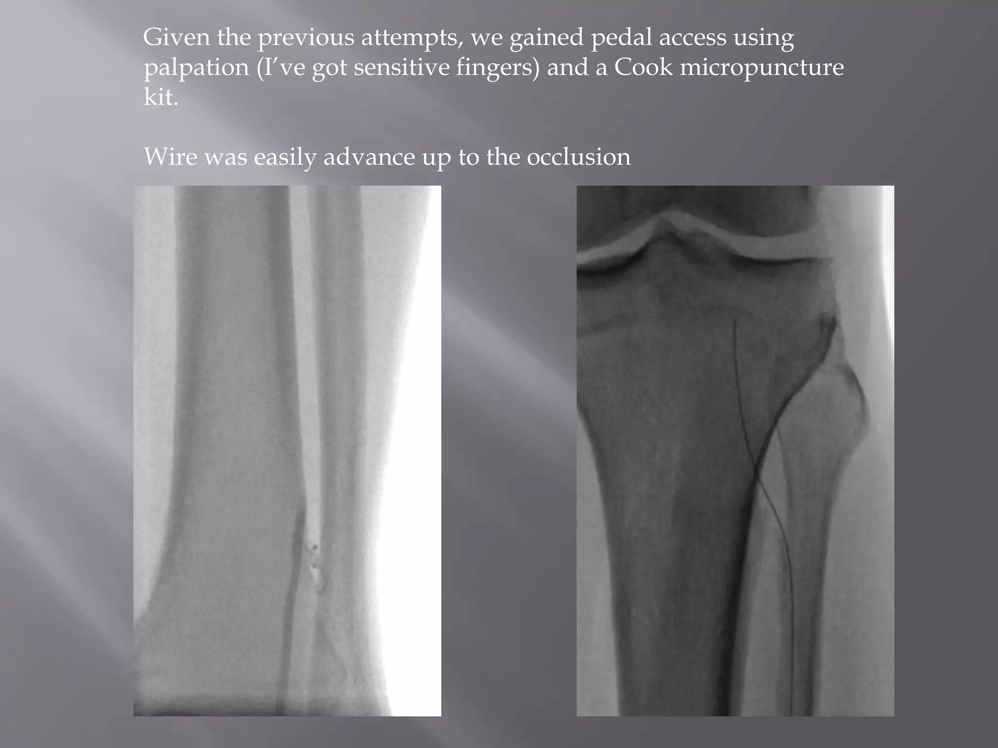 Transpedal SFA revascularization using outback re-entry | PPTX