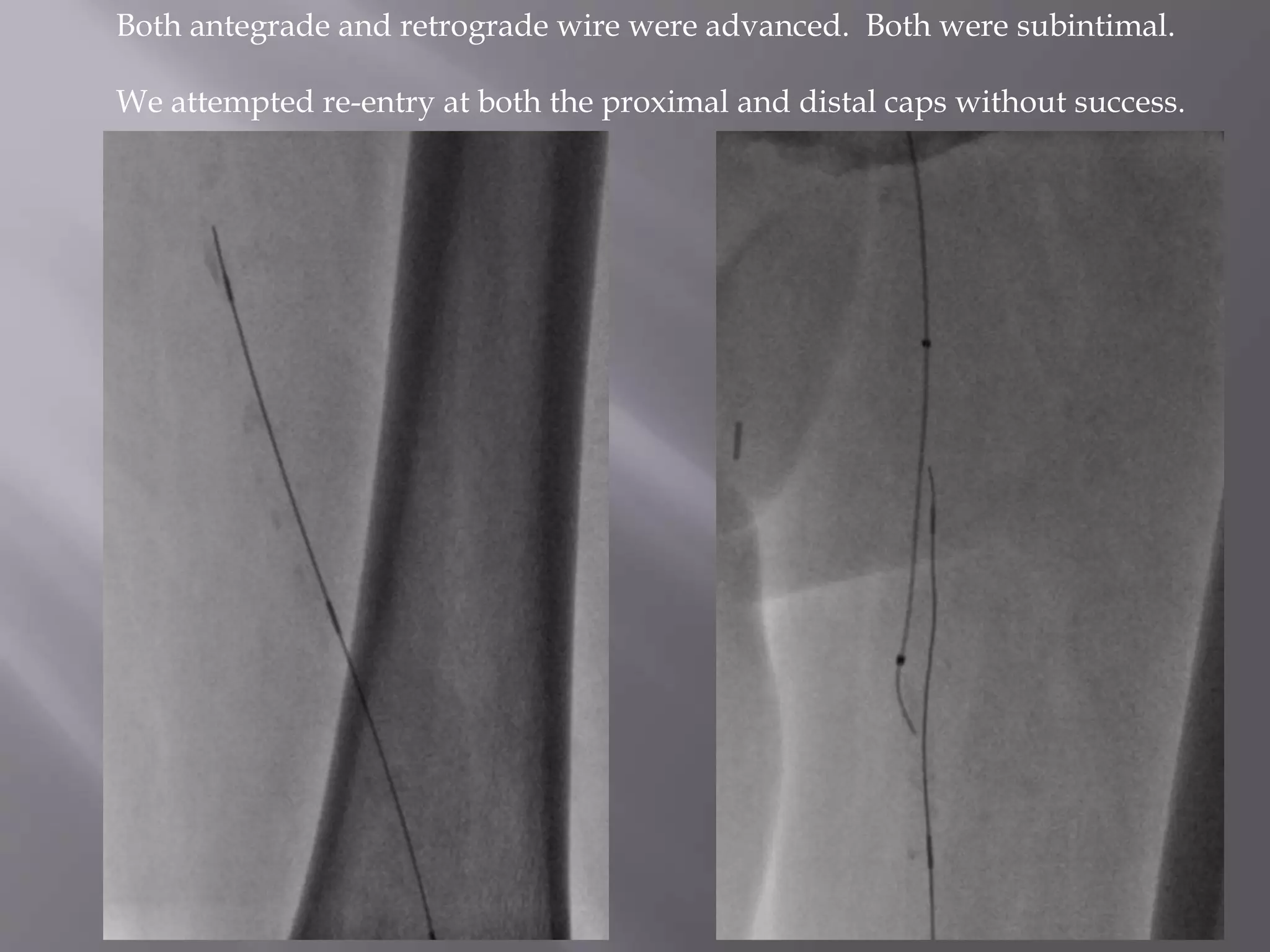 Transpedal SFA revascularization using outback re-entry | PPTX