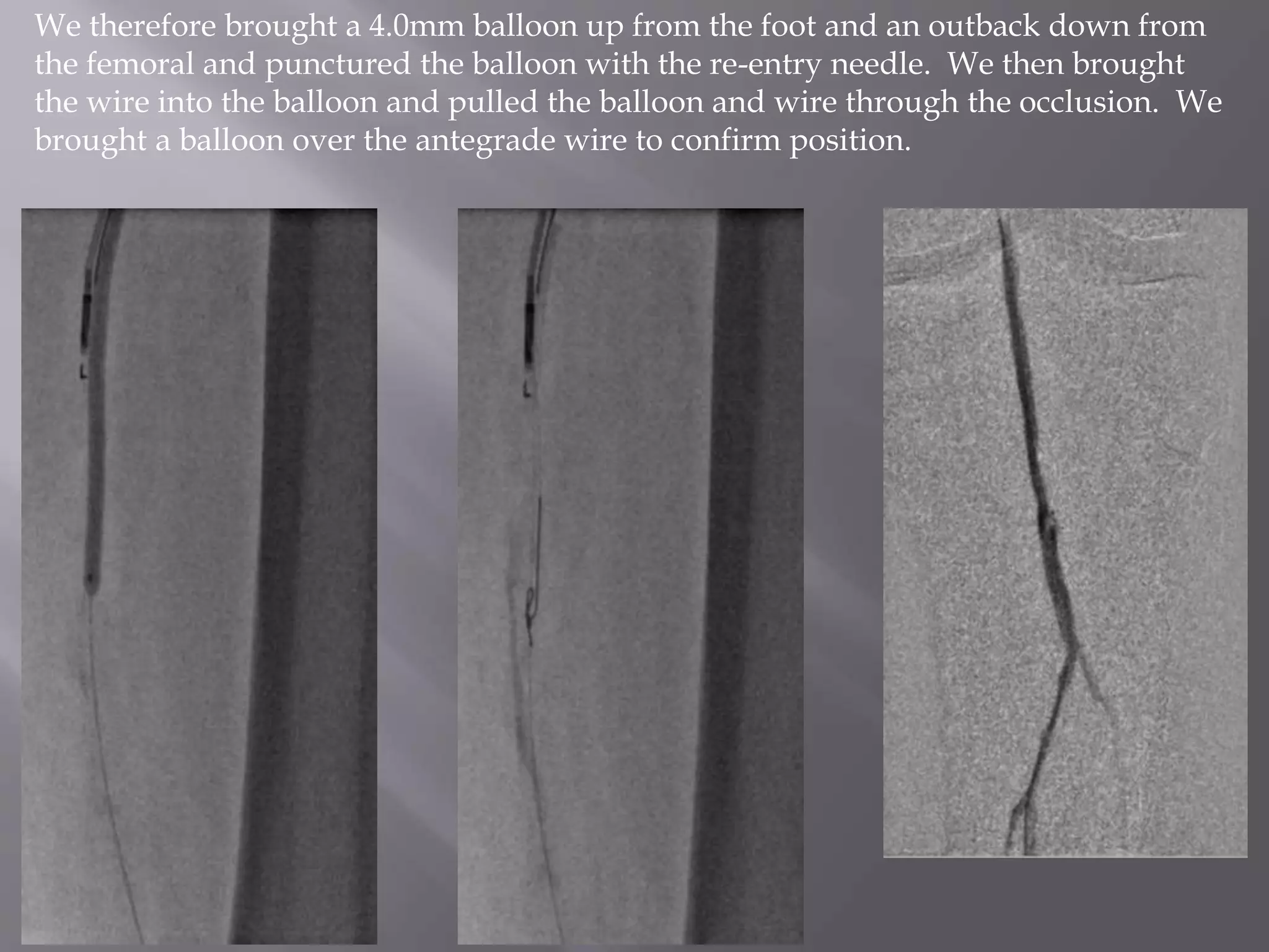 Transpedal SFA revascularization using outback re-entry | PPTX