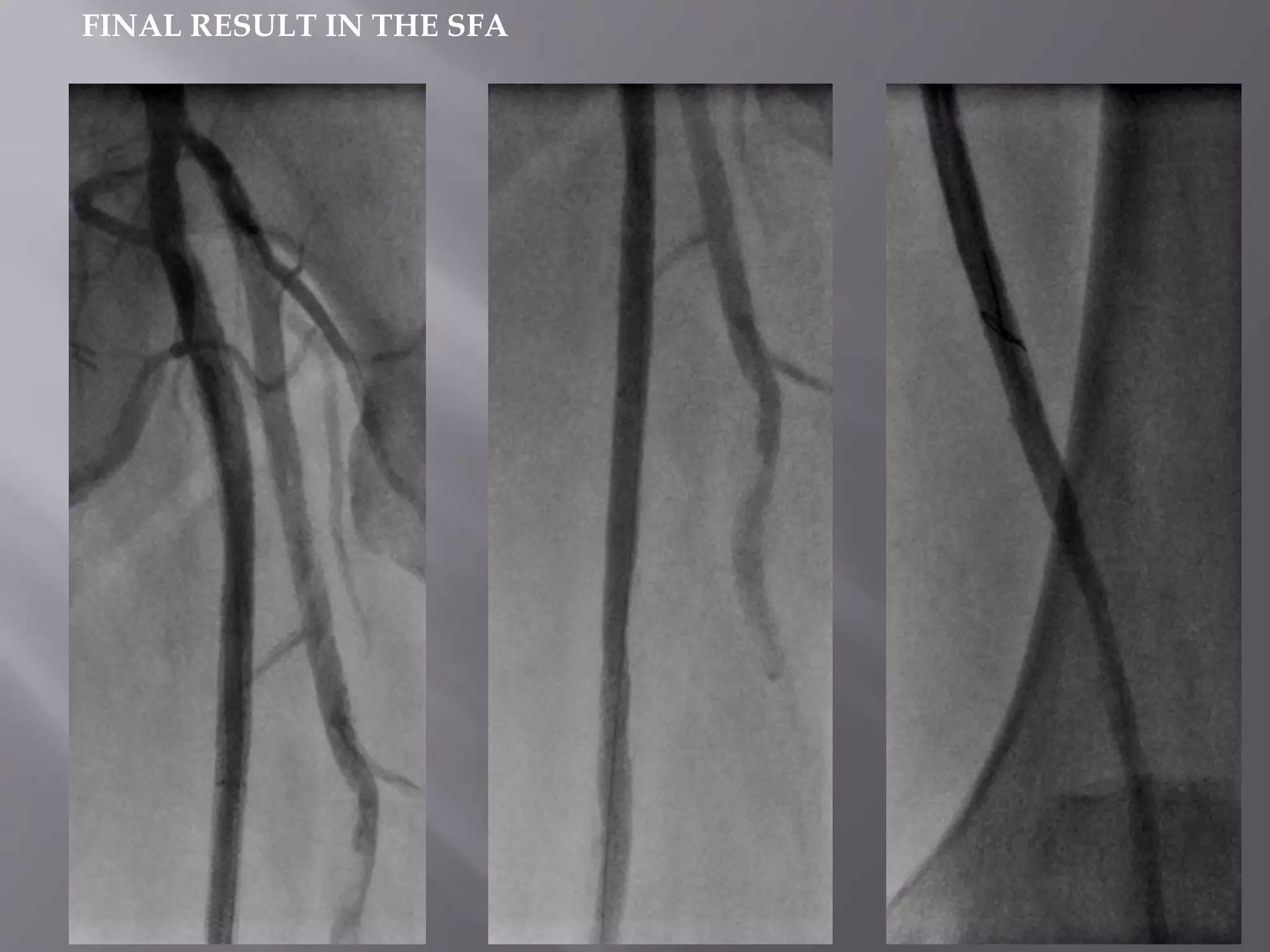 Transpedal SFA revascularization using outback re-entry | PPTX