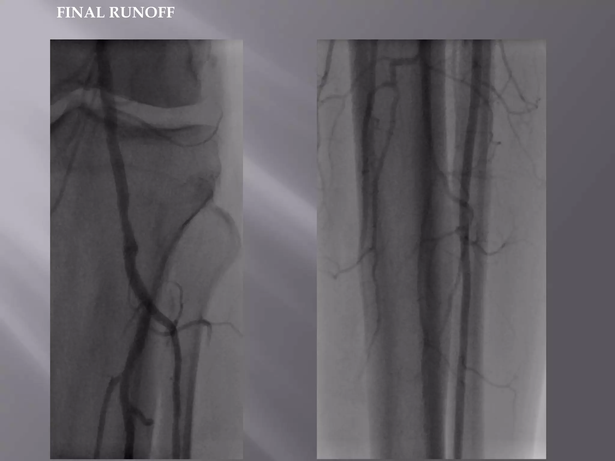 Transpedal SFA revascularization using outback re-entry | PPTX