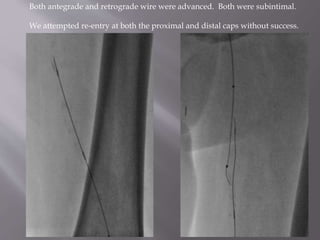 Transpedal SFA revascularization using outback re-entry | PPTX
