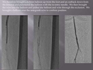 Transpedal SFA revascularization using outback re-entry | PPTX