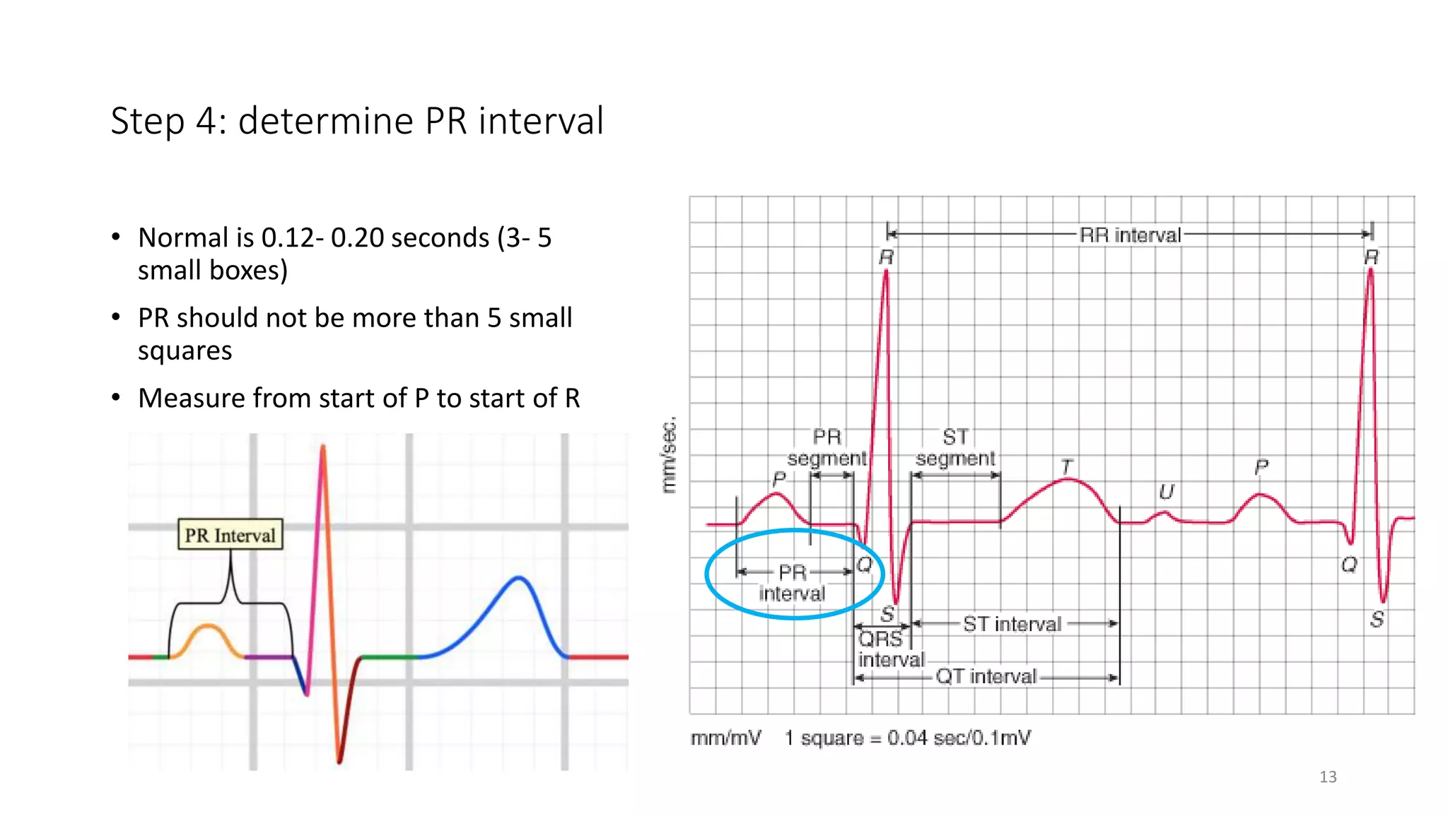 Pediatric ECG Notes | PPTX
