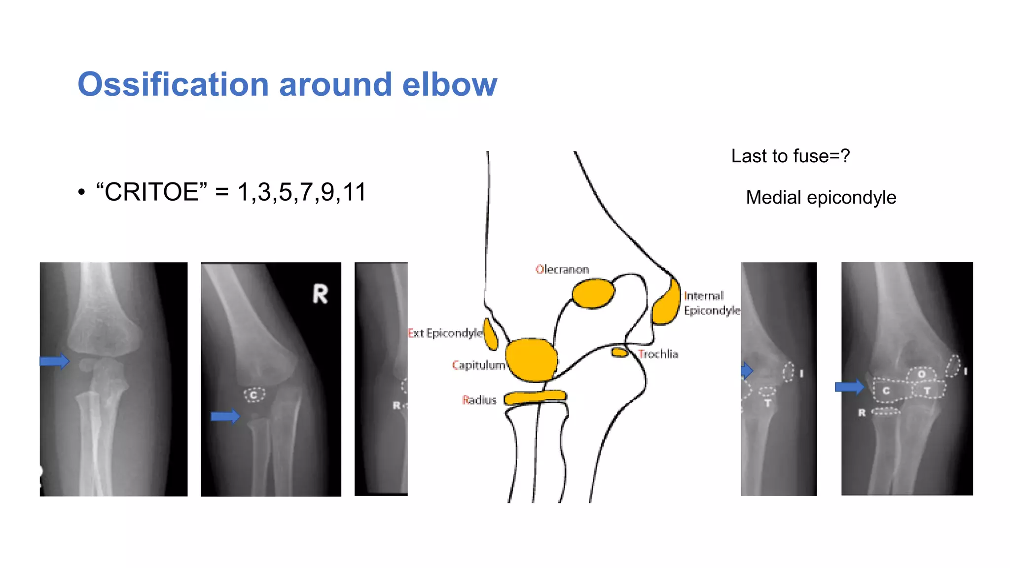 pediatric fracture around elbow.pptx | Death, Injury, or Military ...