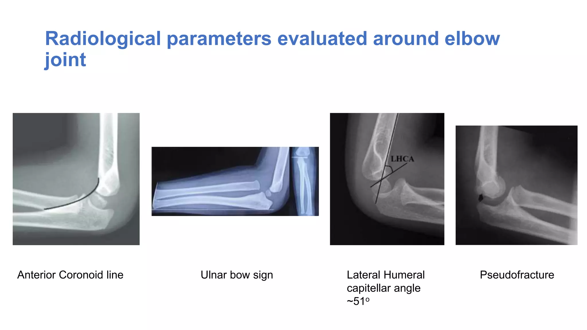 pediatric fracture around elbow.pptx | Death, Injury, or Military ...