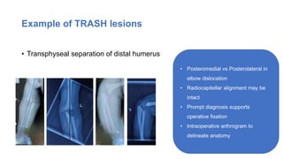 pediatric fracture around elbow.pptx