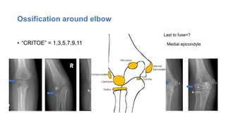 pediatric fracture around elbow.pptx