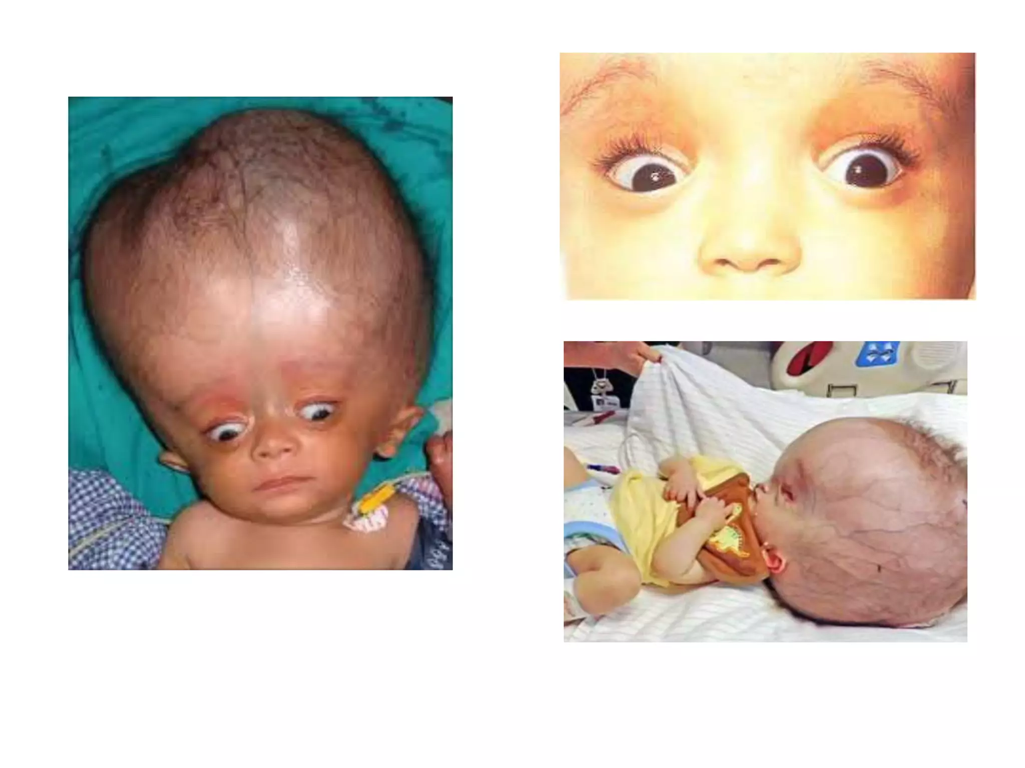 Pediatric Hydrocephalus | PDF