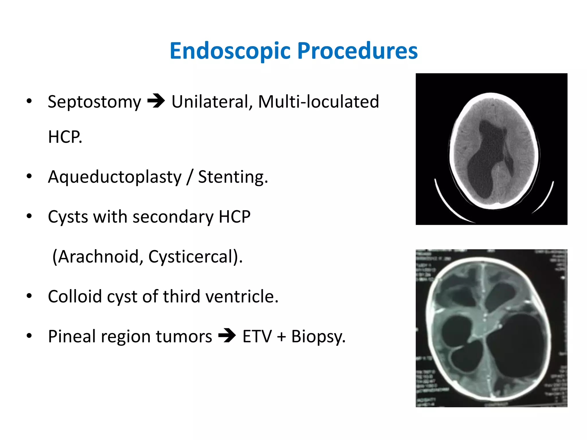 Pediatric Hydrocephalus | PDF