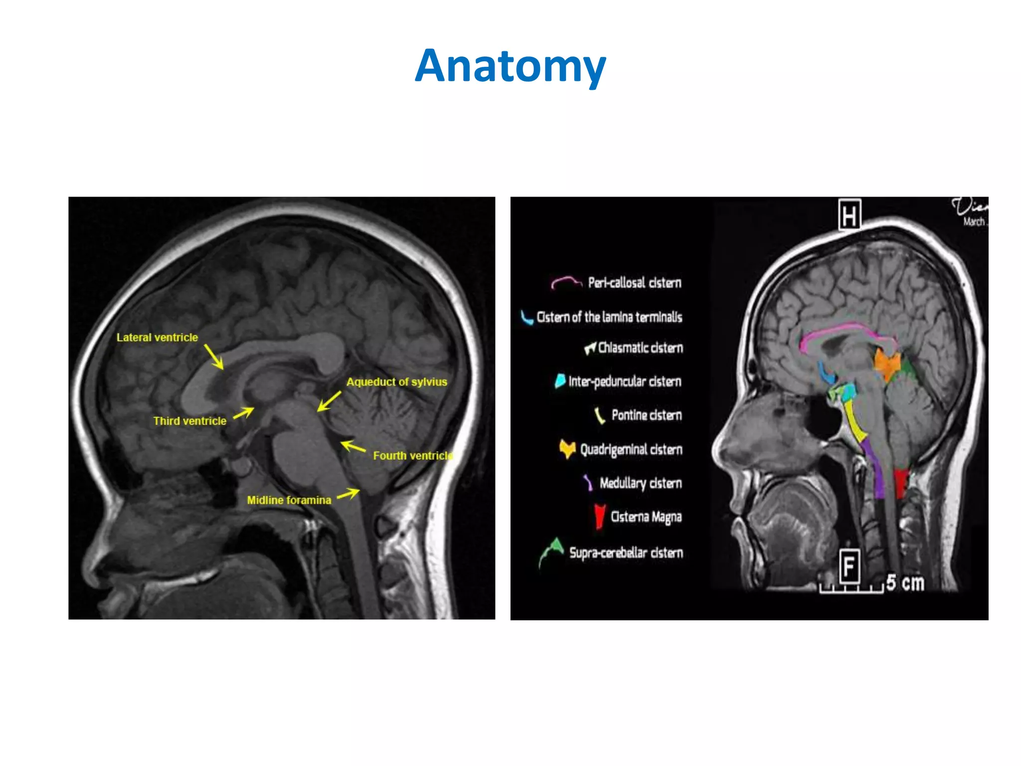 Pediatric Hydrocephalus | PDF