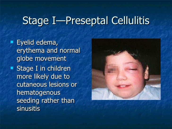 Pediatric Atlas Of Preseptal Periorbital Cellulitis
