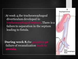 Tracheoesophageal Fistula || TEF || Esophageal fistula | PDF
