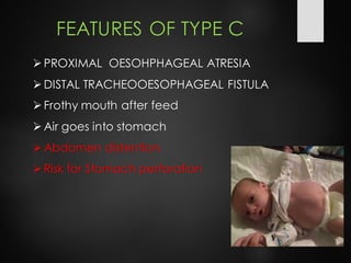 Tracheoesophageal Fistula || TEF || Esophageal fistula | PDF