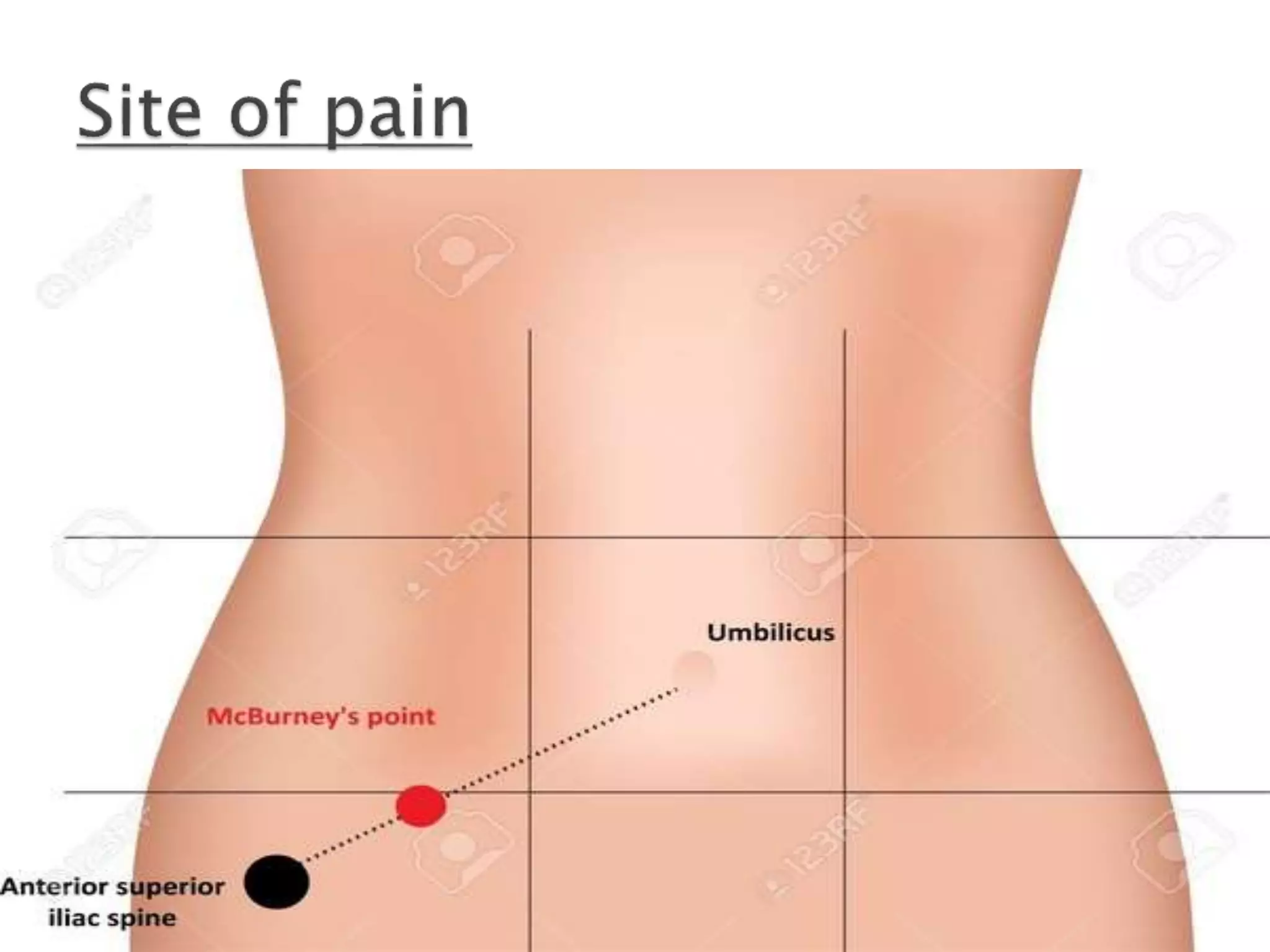Pedi appendicitis | PPTX