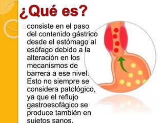 constipacion,reflujo gastroesofagico,caracteristicas y cuidados del ...