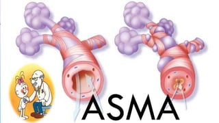 asma bronquial completo en pediatria pptx | PPTX