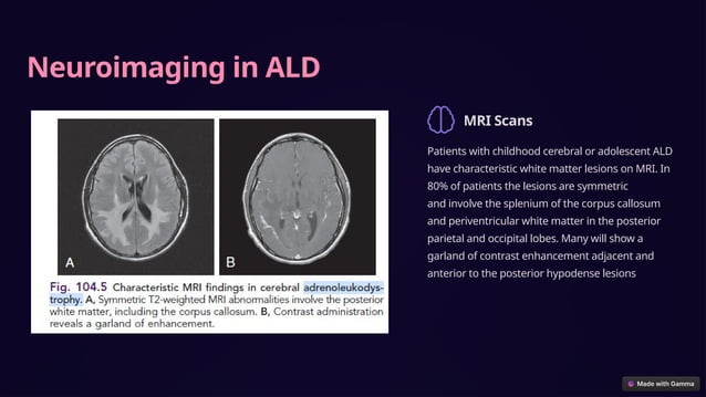 Pediatric Adrenoleukodystrophy (ALD).pptx