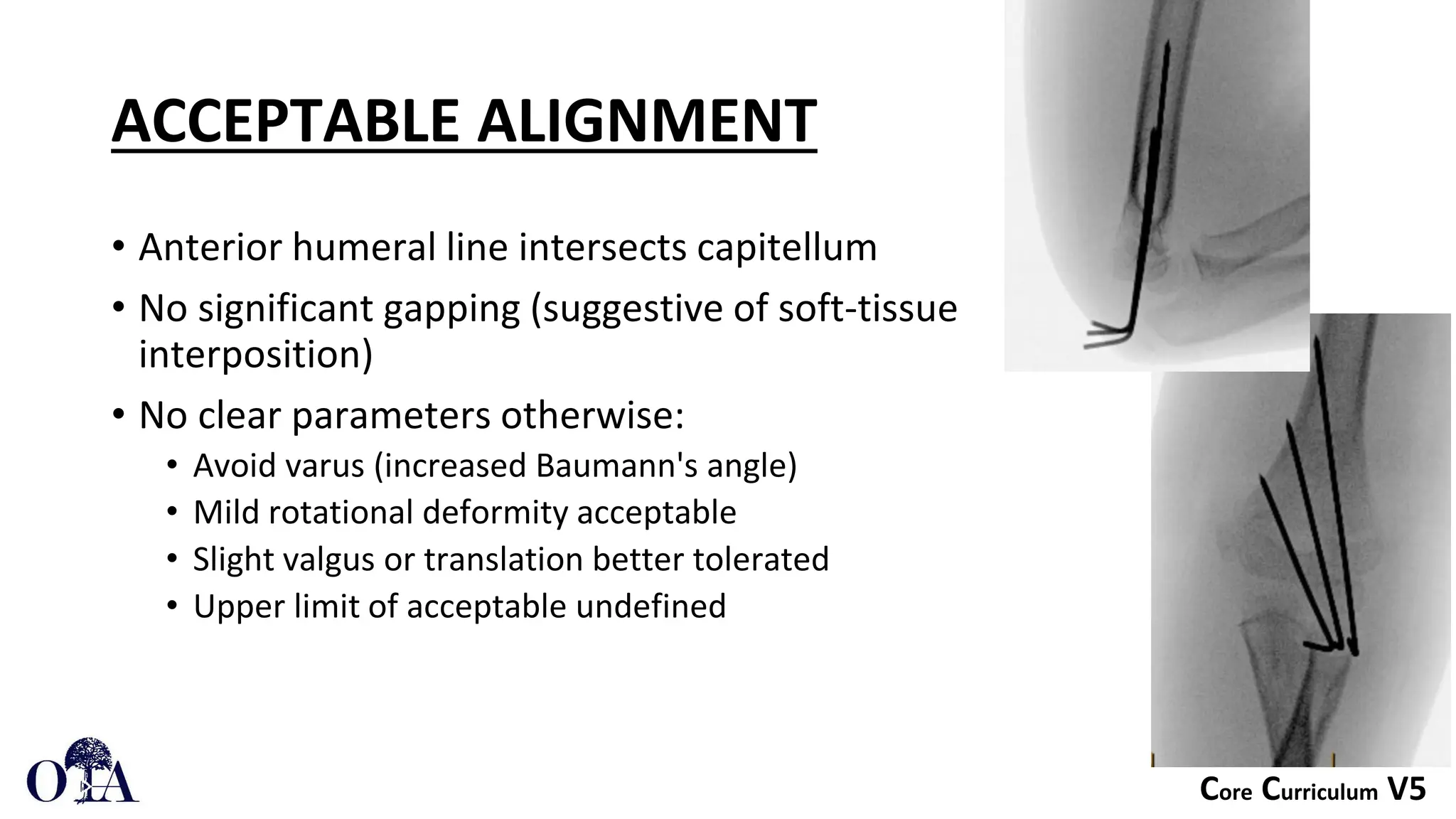 Pediatric2 Supracondylar Humerus Fractures.pdf