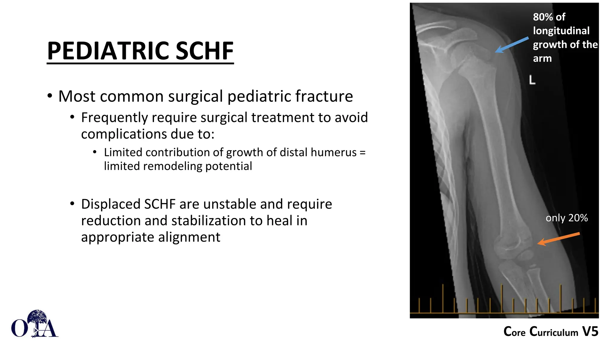 Pediatric2 Supracondylar Humerus Fractures.pdf