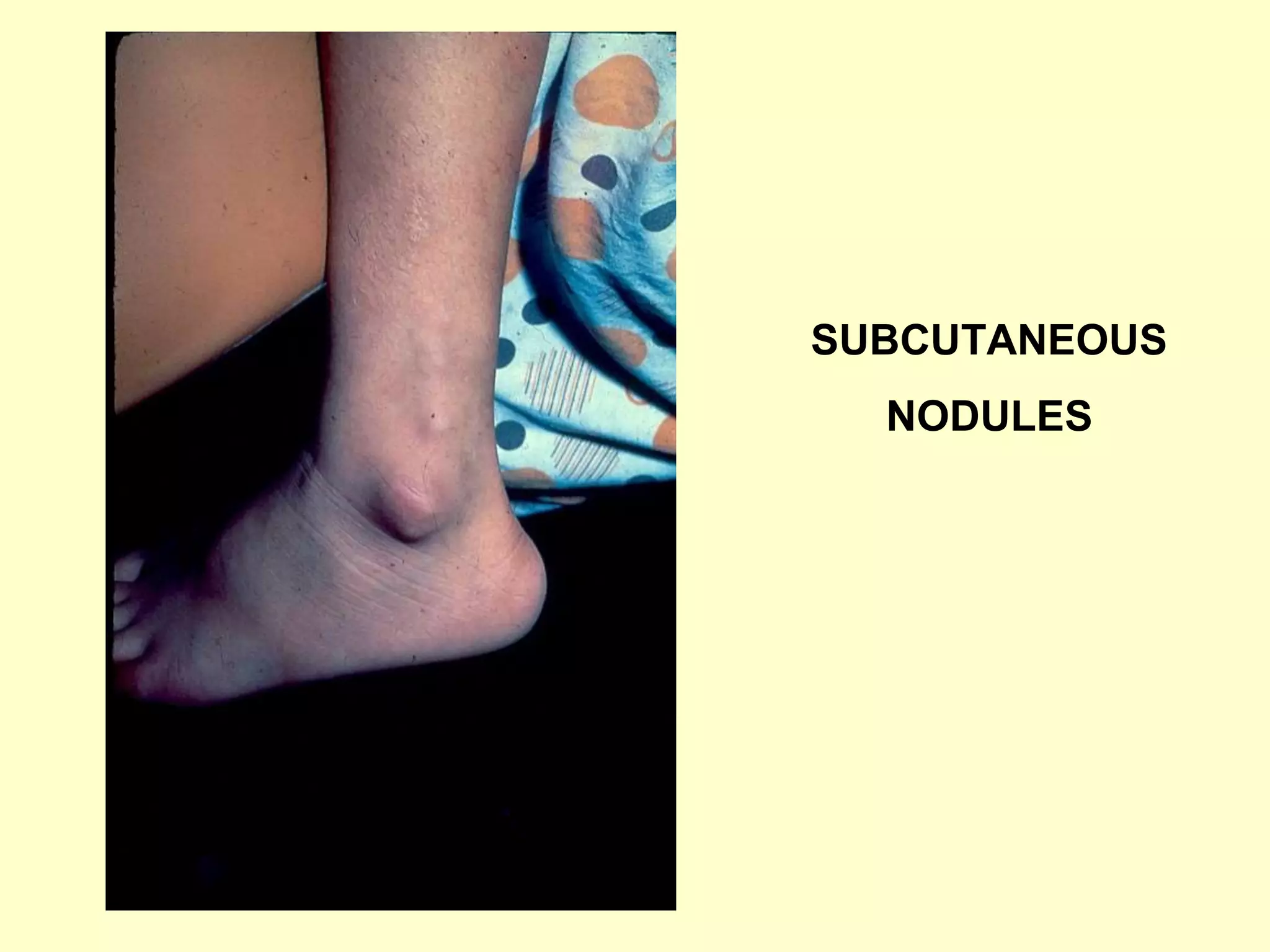 Pediatric Acquired Heart Diseases - Rivin | PPTX