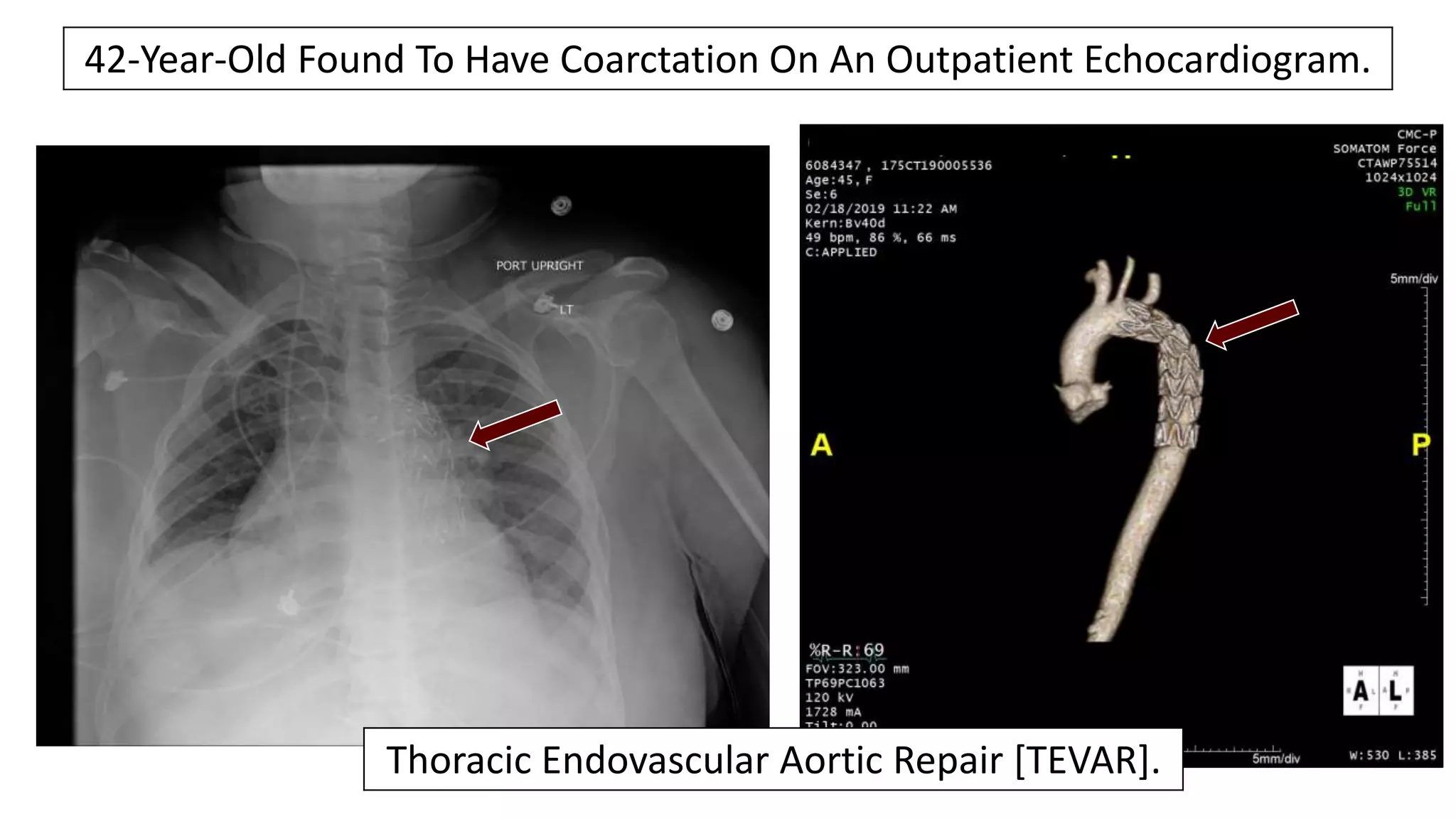 EMGuideWire's Radiology Reading Room on Pediatric Adult Aortic ...