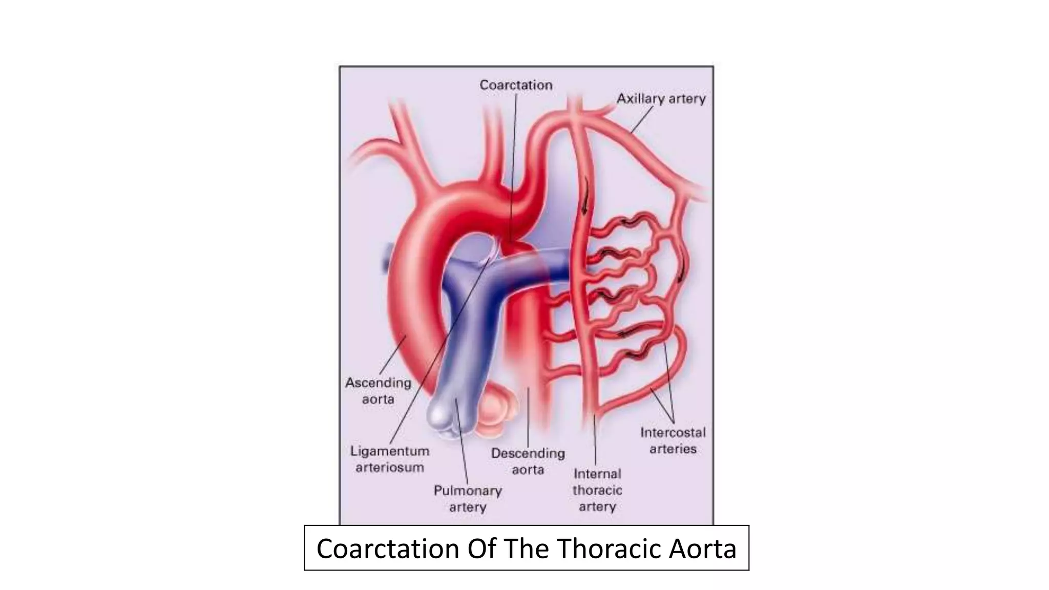 EMGuideWire's Radiology Reading Room on Pediatric Adult Aortic ...