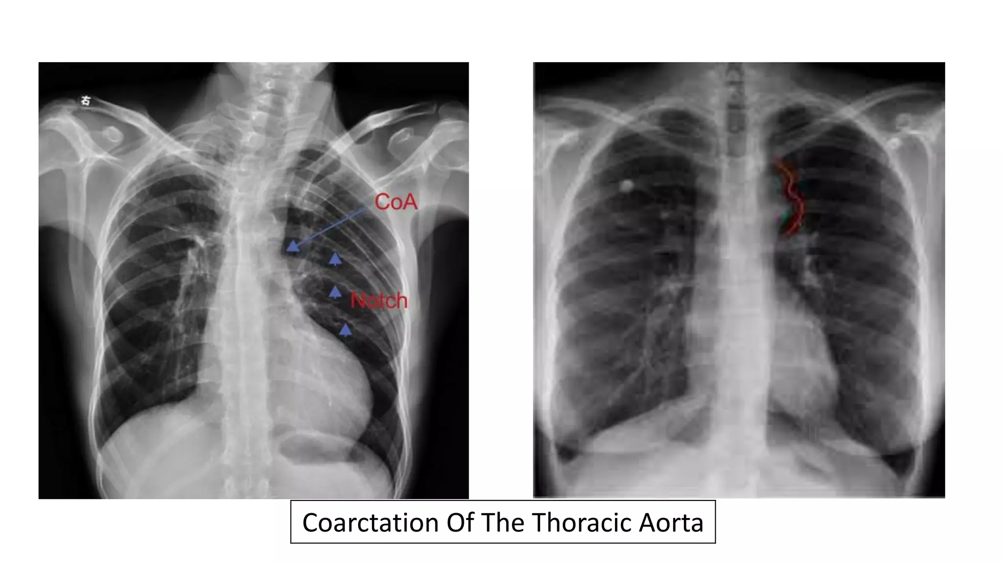 EMGuideWire's Radiology Reading Room on Pediatric Adult Aortic ...