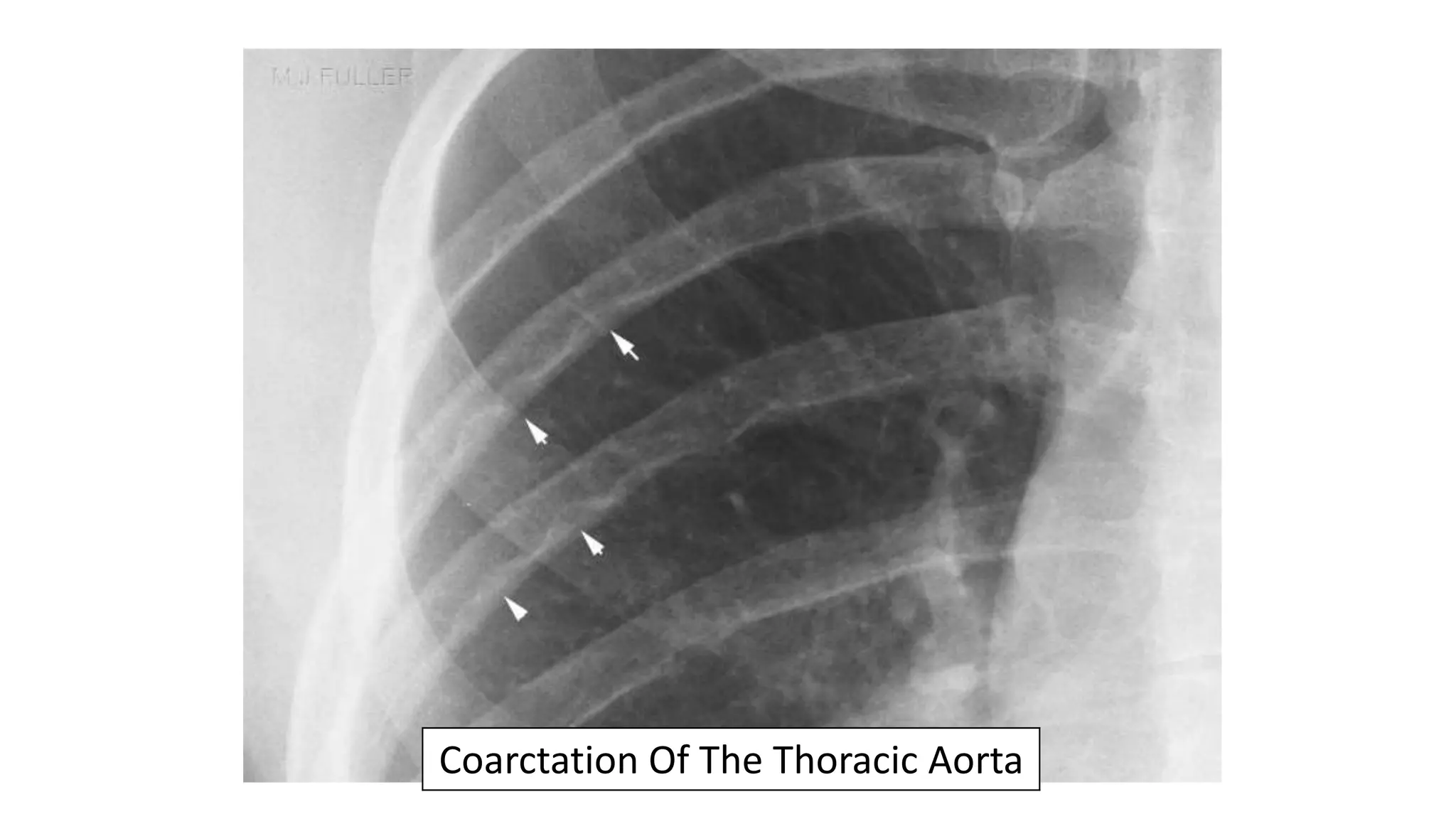 EMGuideWire's Radiology Reading Room on Pediatric Adult Aortic ...