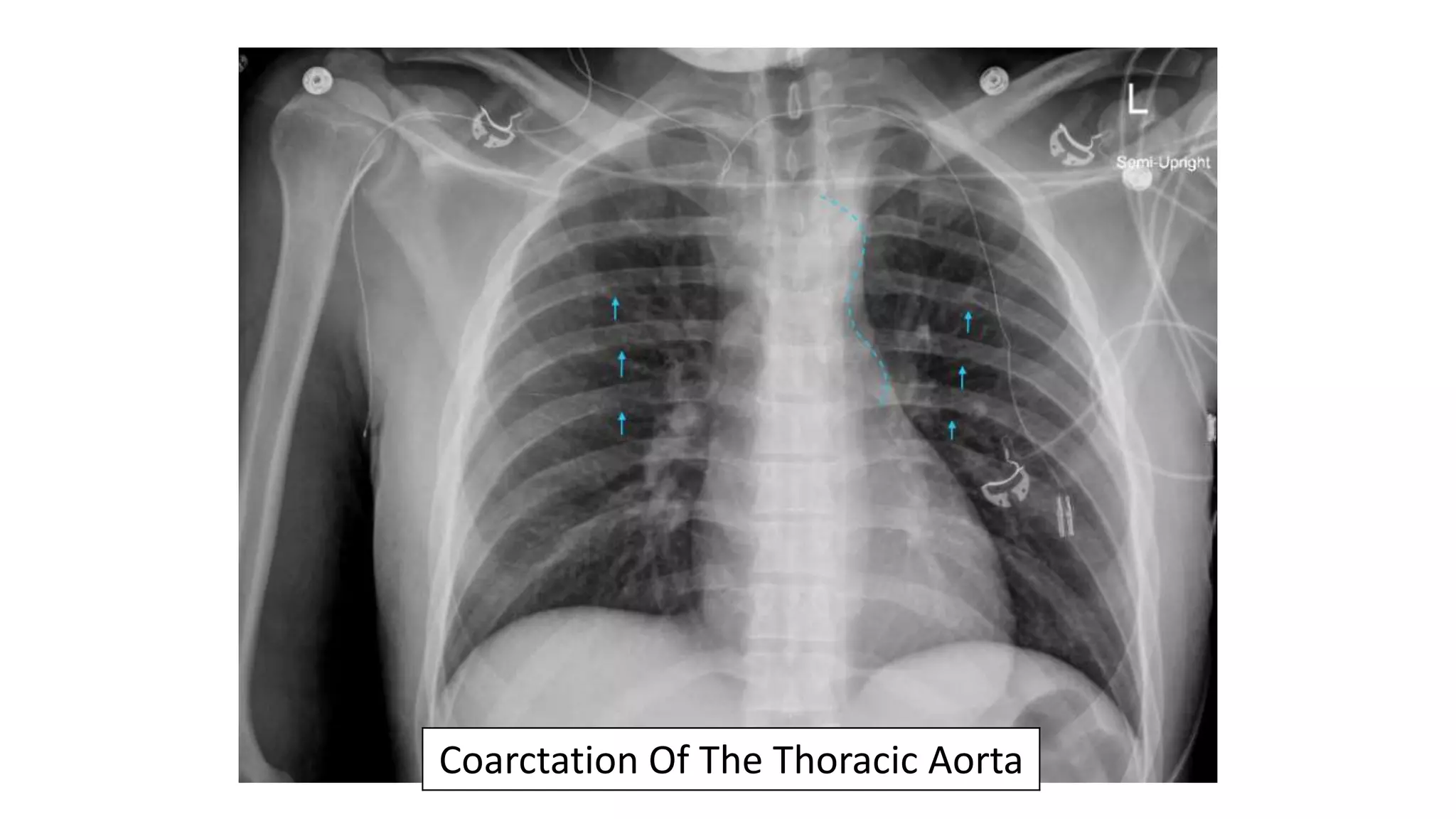 EMGuideWire's Radiology Reading Room on Pediatric Adult Aortic ...