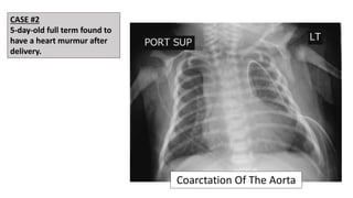 EMGuideWire's Radiology Reading Room on Pediatric Adult Aortic ...