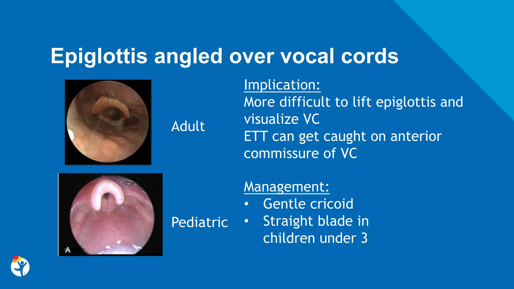 Pediatric Airway Management | PDF