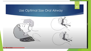 PEDIATRIC AIRWAY comparison between adults | PPTX