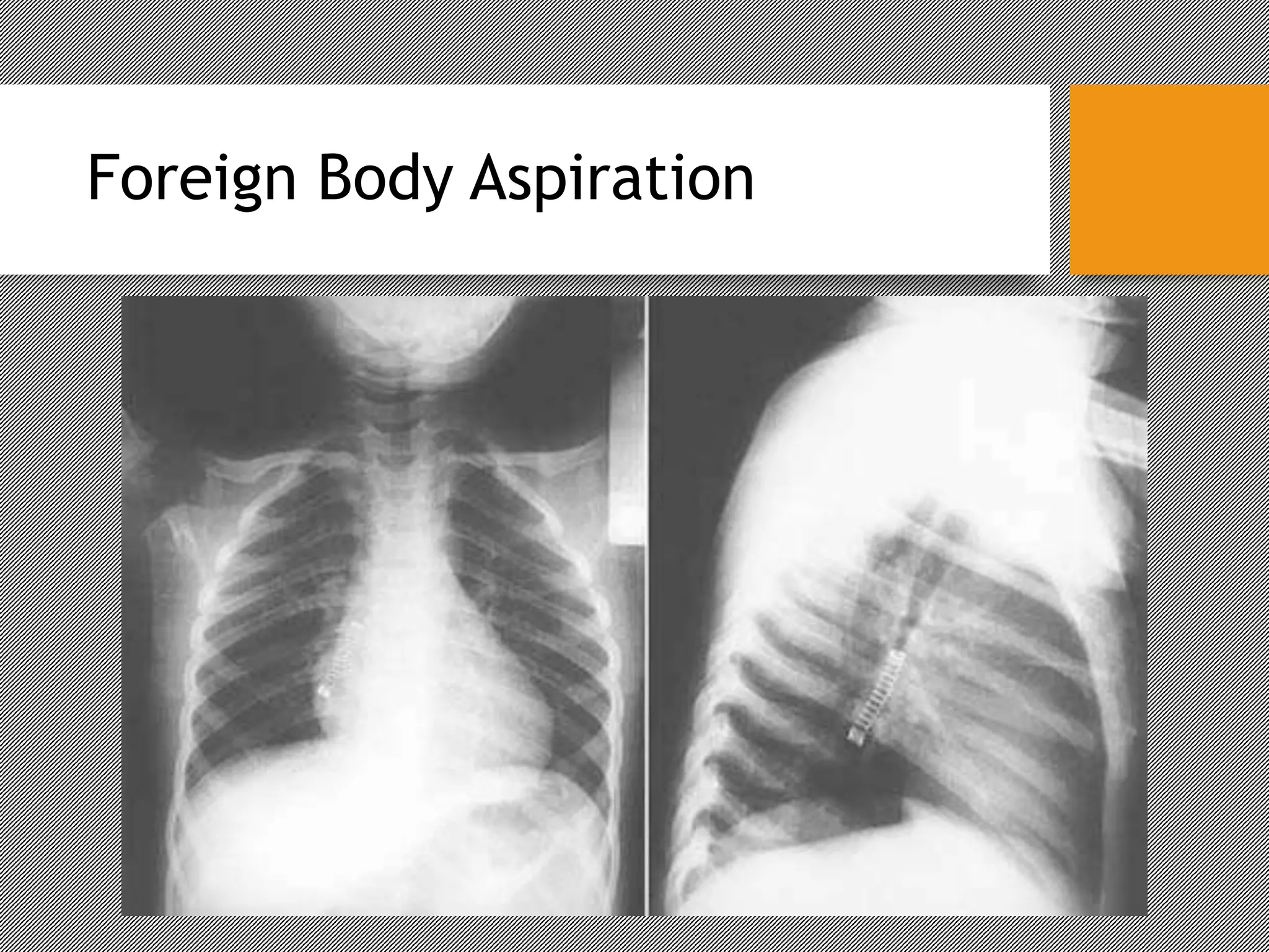 Pediatric airway foreign body | PPT