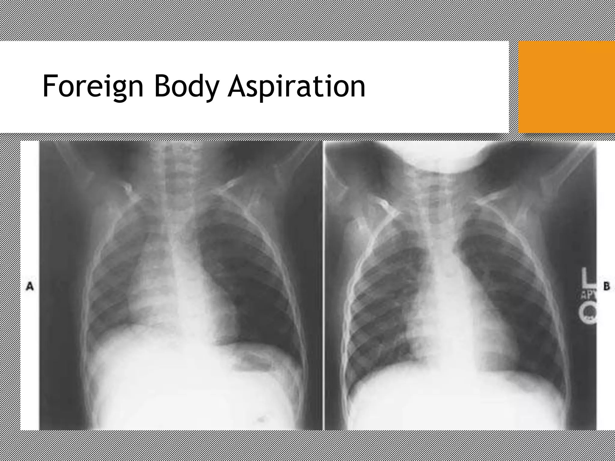 Pediatric airway foreign body | PPT