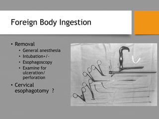 Pediatric airway foreign body | PPT