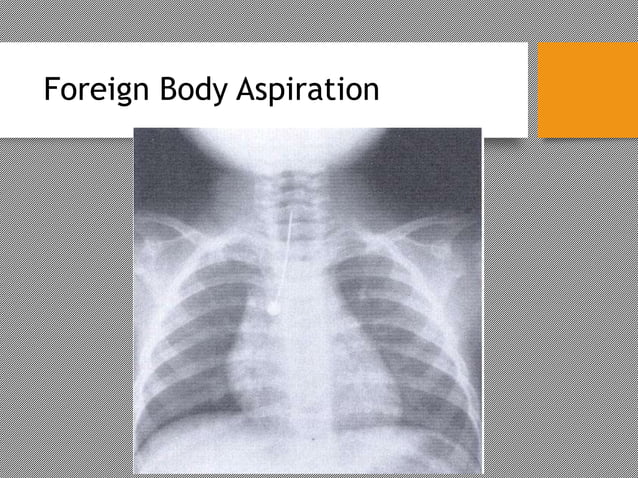 Pediatric airway foreign body | PPT | Lung and Respiratory Health | Diseases and Conditions