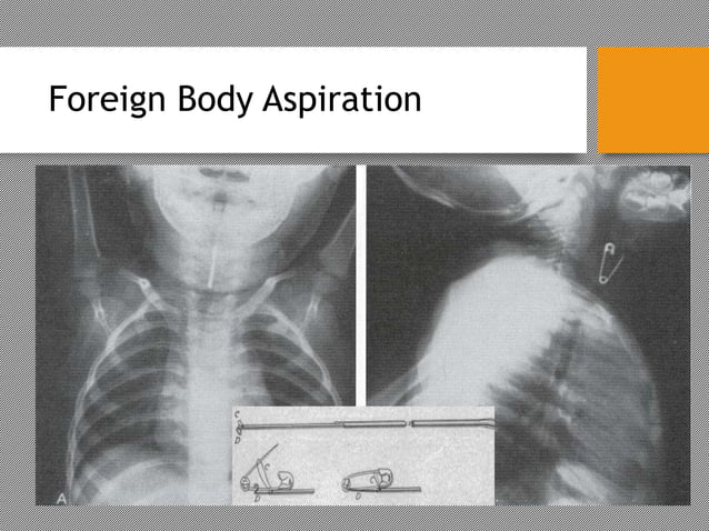 Pediatric airway foreign body | PPT | Lung and Respiratory Health ...
