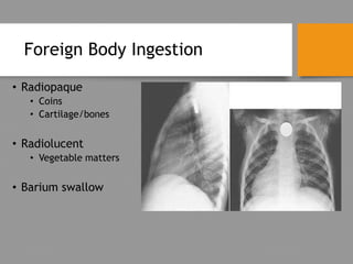 Pediatric airway foreign body | PPT